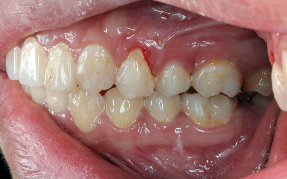 Ontstoken tandvlees? Zó verhelp je het zelf! - ROOTS